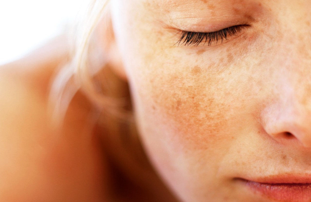 Melasma Treatment - How to Effectively Get Rid of Melasma