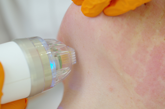 Do At-Home Microneedling Kits Work? | The Beautiful Lifestyle Online